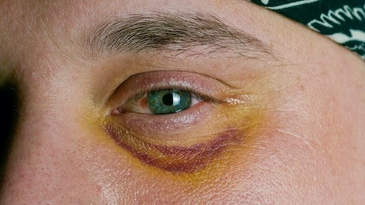 Why Do Bruises Change Colors?