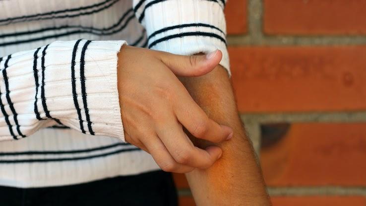 What Is the Best Treatment for Atopic Dermatitis?