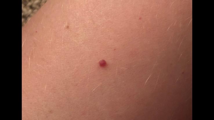 Spotting The Difference Melanoma Age Spots And Sun Spots