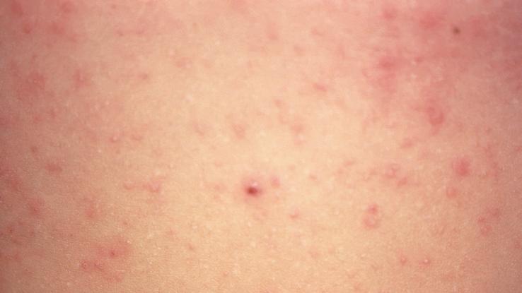 Ouch! What Bit Me? How to Identify 10 Common Bug Bites