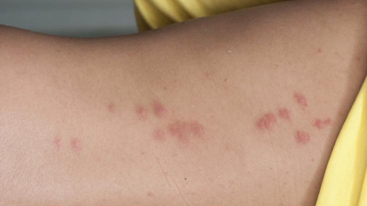 Ouch! What Bit Me? How to Identify 10 Common Bug Bites